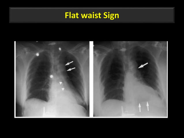 Deep sulcus sign fallen lung sign-ct angiogram sign-flat-waist sign ...