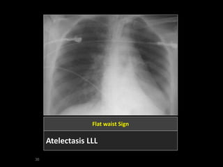 Deep sulcus sign fallen lung sign-ct angiogram sign-flat-waist sign | PPTX