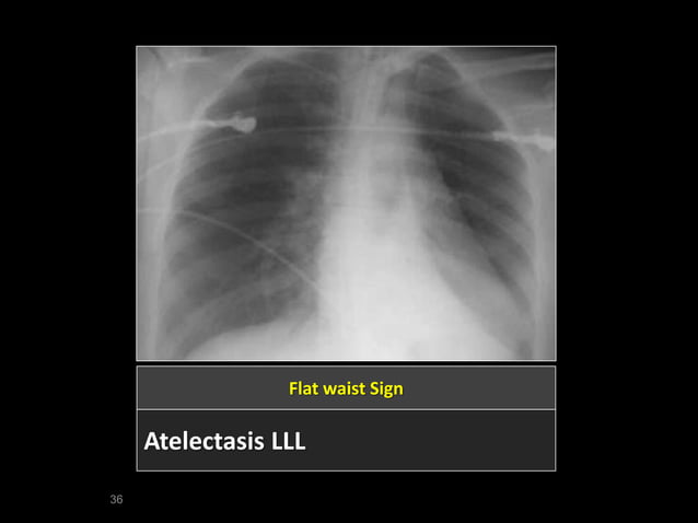 Deep sulcus sign fallen lung sign-ct angiogram sign-flat-waist sign ...