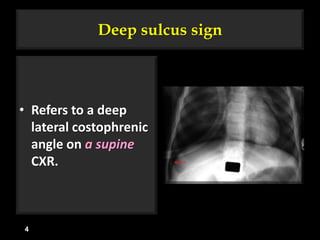 Deep sulcus sign fallen lung sign-ct angiogram sign-flat-waist sign | PPT