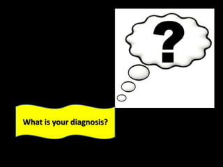 Deep sulcus sign fallen lung sign-ct angiogram sign-flat-waist sign | PPT