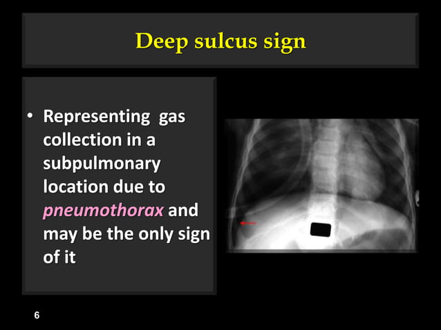 Deep sulcus sign fallen lung sign-ct angiogram sign-flat-waist sign ...