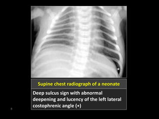 Deep sulcus sign fallen lung sign-ct angiogram sign-flat-waist sign | PPTX