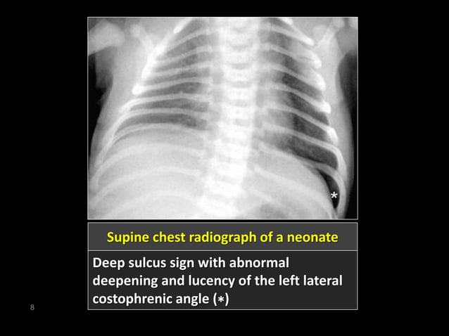 Deep sulcus sign fallen lung sign-ct angiogram sign-flat-waist sign ...
