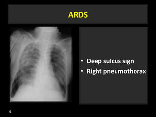 Deep sulcus sign fallen lung sign-ct angiogram sign-flat-waist sign | PPT