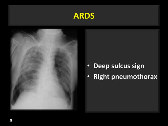 Deep sulcus sign fallen lung sign-ct angiogram sign-flat-waist sign ...