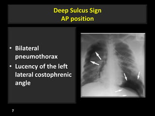 Deep sulcus sign fallen lung sign-ct angiogram sign-flat-waist sign | PPT