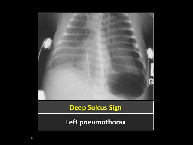 Deep sulcus sign fallen lung sign-ct angiogram sign-flat-waist sign