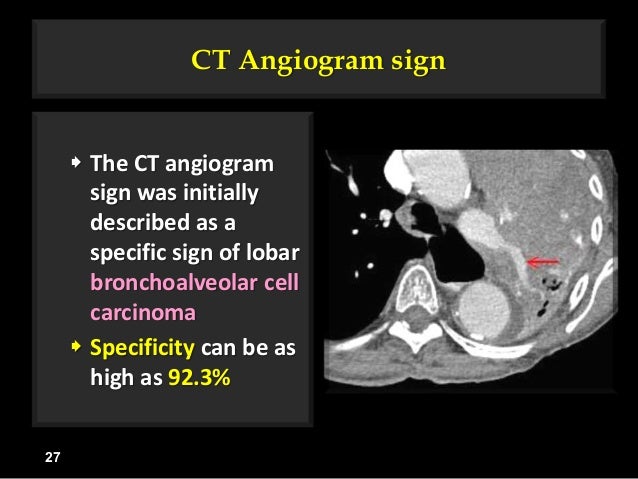 Deep sulcus sign fallen lung sign-ct angiogram sign-flat-waist sign