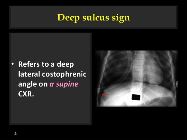 Deep sulcus sign fallen lung sign-ct angiogram sign-flat-waist sign