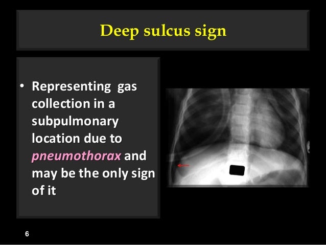 Deep sulcus sign fallen lung sign-ct angiogram sign-flat-waist sign