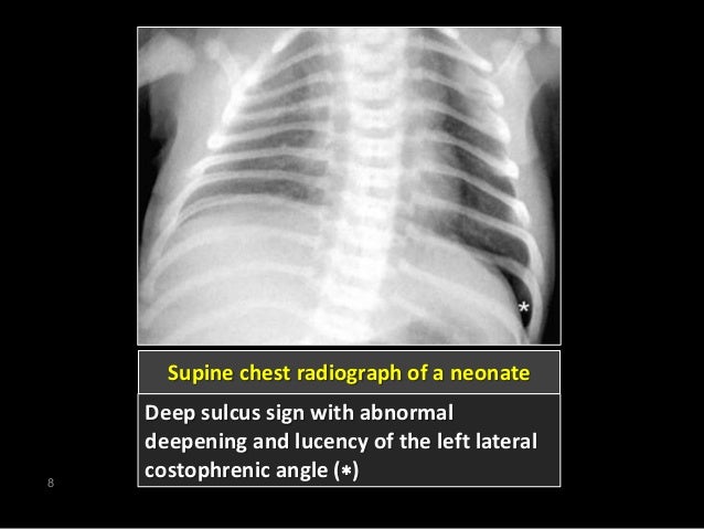 Deep sulcus sign fallen lung sign-ct angiogram sign-flat-waist sign