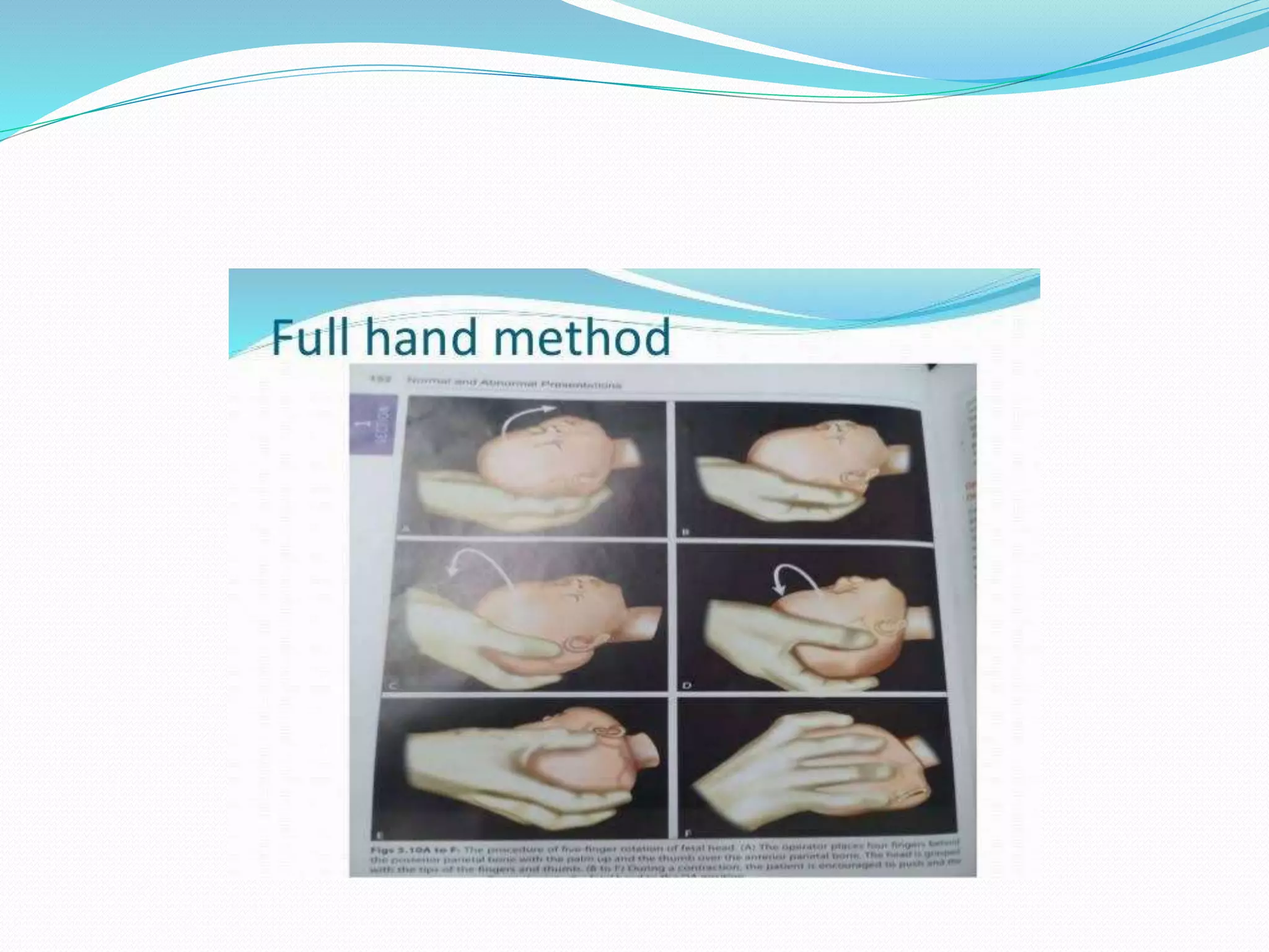 Deep transverse arrest | PPTX