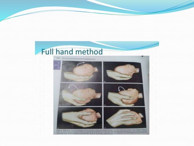 Deep transverse arrest | PPT