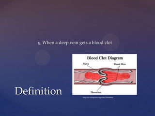 Deep vein thrombosis | PPT