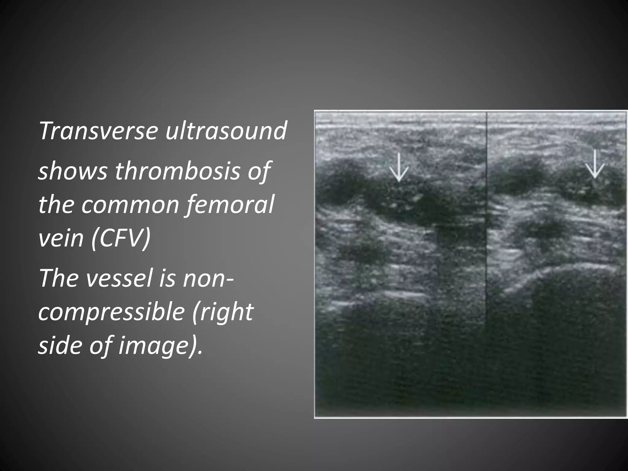 Deep vein thrombosis | PPTX