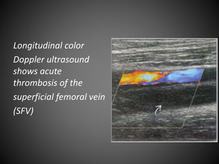 Deep vein thrombosis | PPTX