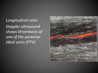 Deep vein thrombosis | PPTX