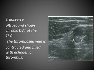 Deep vein thrombosis | PPTX