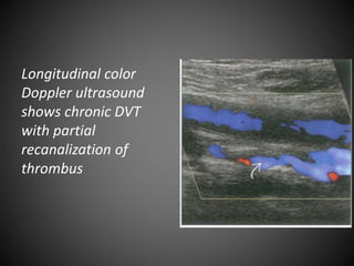 Deep vein thrombosis | PPTX