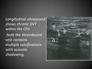 Deep vein thrombosis | PPTX