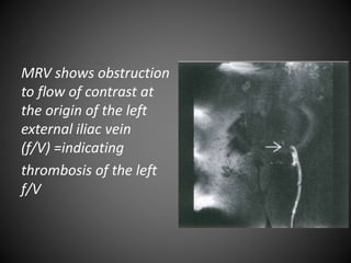 Deep vein thrombosis | PPTX