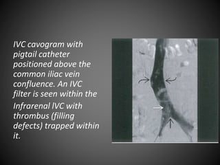 Deep vein thrombosis | PPTX