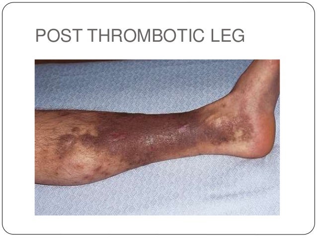 Deep vein thrombosis