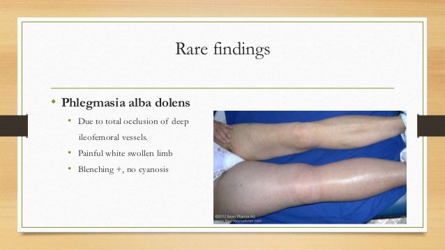 Deep vein thrombosis