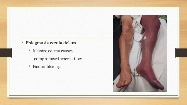 Deep vein thrombosis