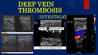Deep vein thrombosis- Venous diseases | PPTX