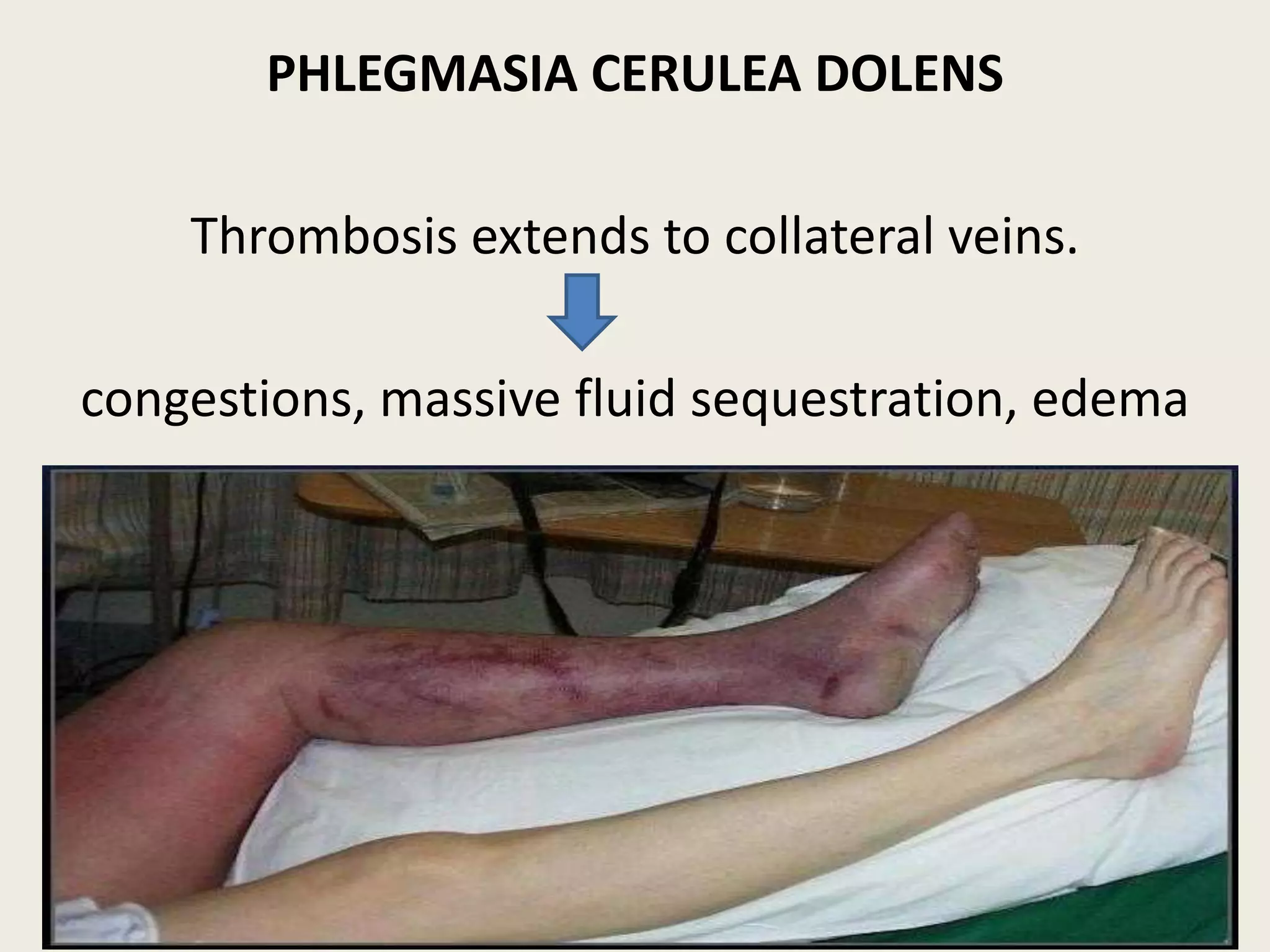 Deep vein thrombosis | PPTX