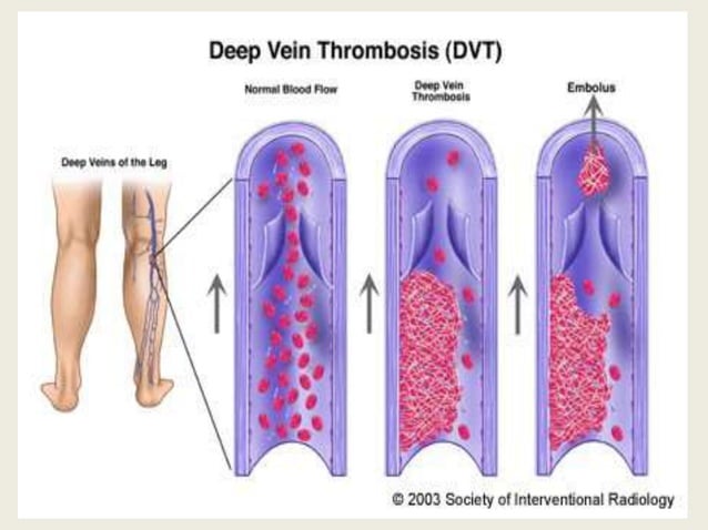 Deep vein thrombosis | PPTX