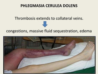 Deep vein thrombosis | PPTX