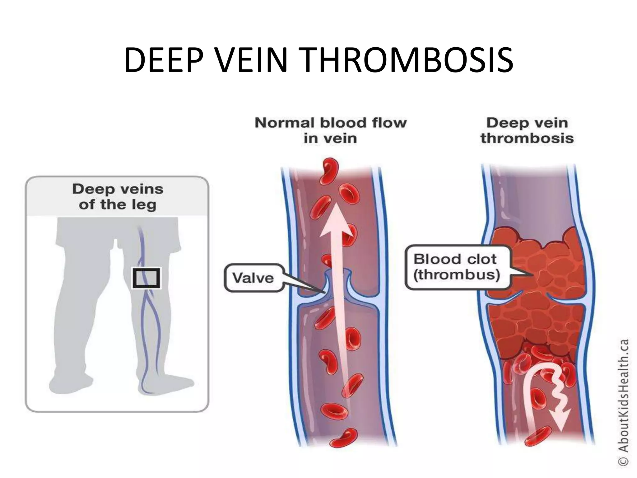 Deep vein thrombosis (DVT) | PPTX