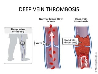 Deep vein thrombosis (DVT) | PPTX