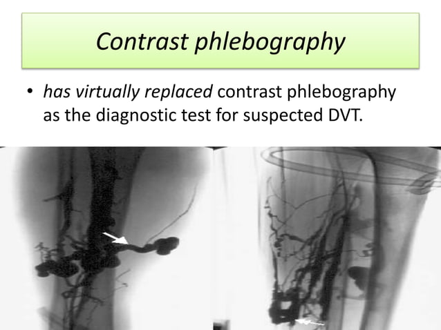 Deep vein thrombosis (DVT) | PPTX | Blood Disorders | Diseases and ...
