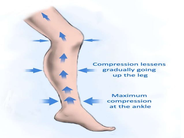 Deep vein thrombosis (DVT) | PPTX | Blood Disorders | Diseases and ...