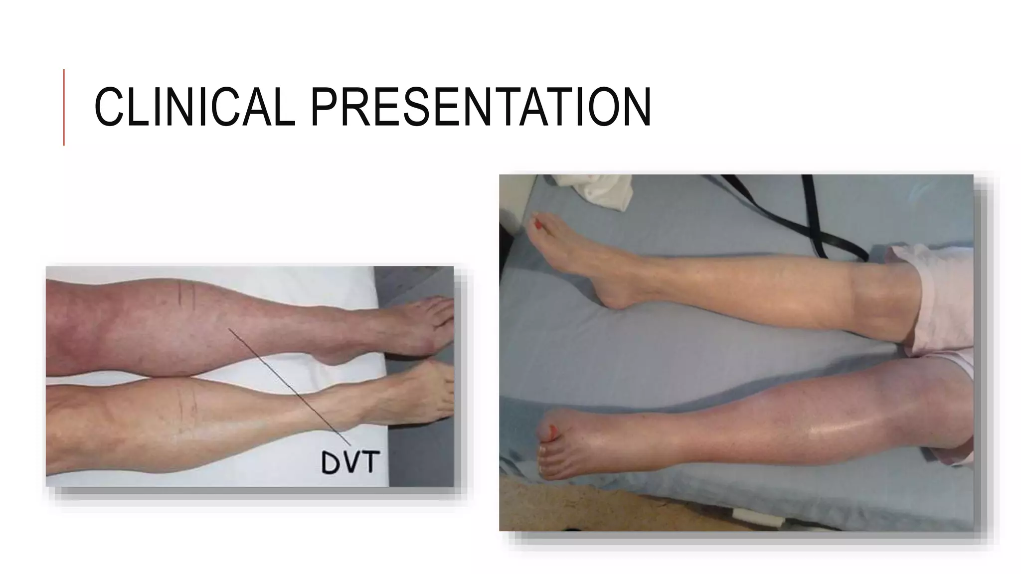 Deep Vein Thrombosis | PPTX