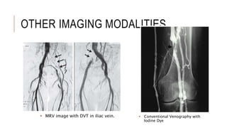 Deep Vein Thrombosis | PPT