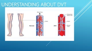 Deep vein thrombosis | PPTX | Blood Disorders | Diseases and Conditions