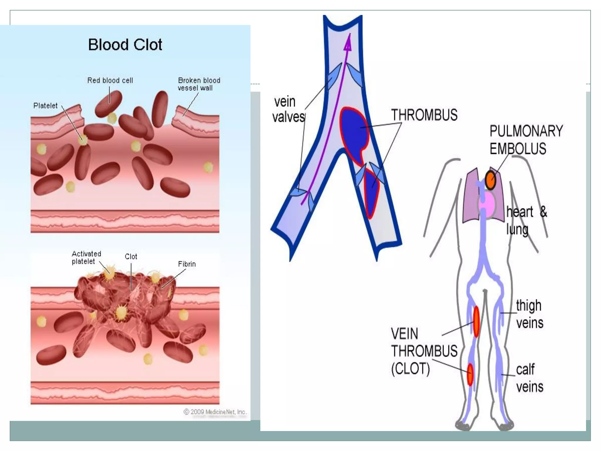 DVT (Deep vein thrombosis) | PDF