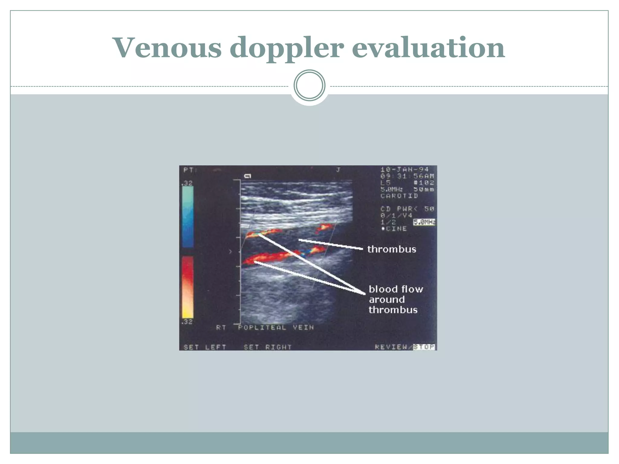 DVT (Deep vein thrombosis) | PDF