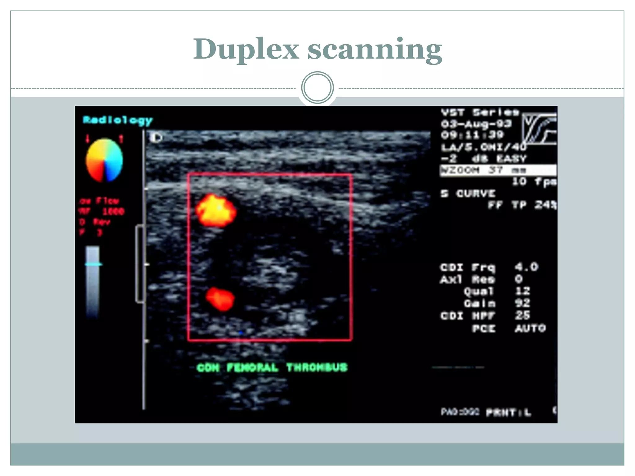 DVT (Deep vein thrombosis) | PDF