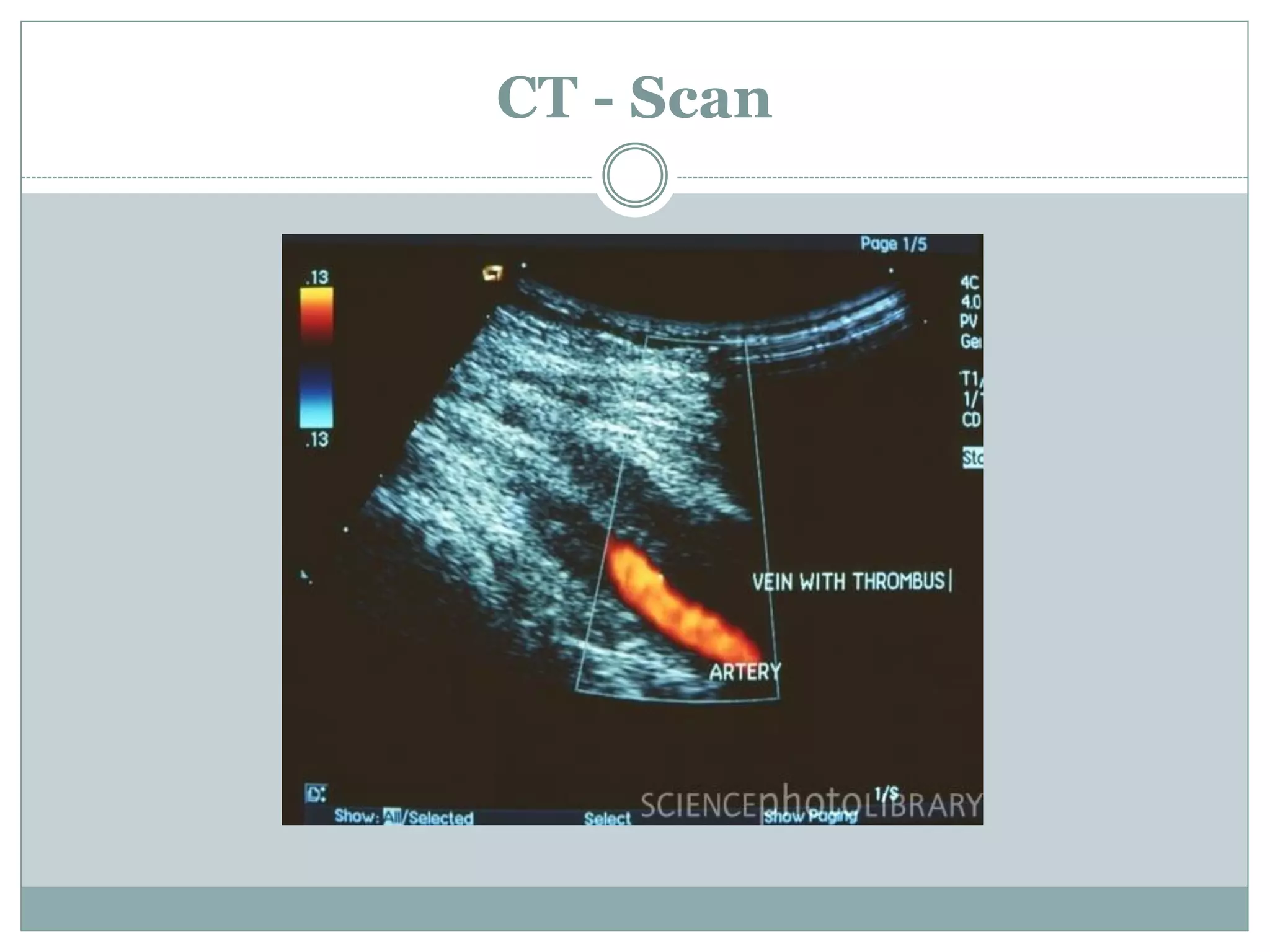 DVT (Deep vein thrombosis) | PDF