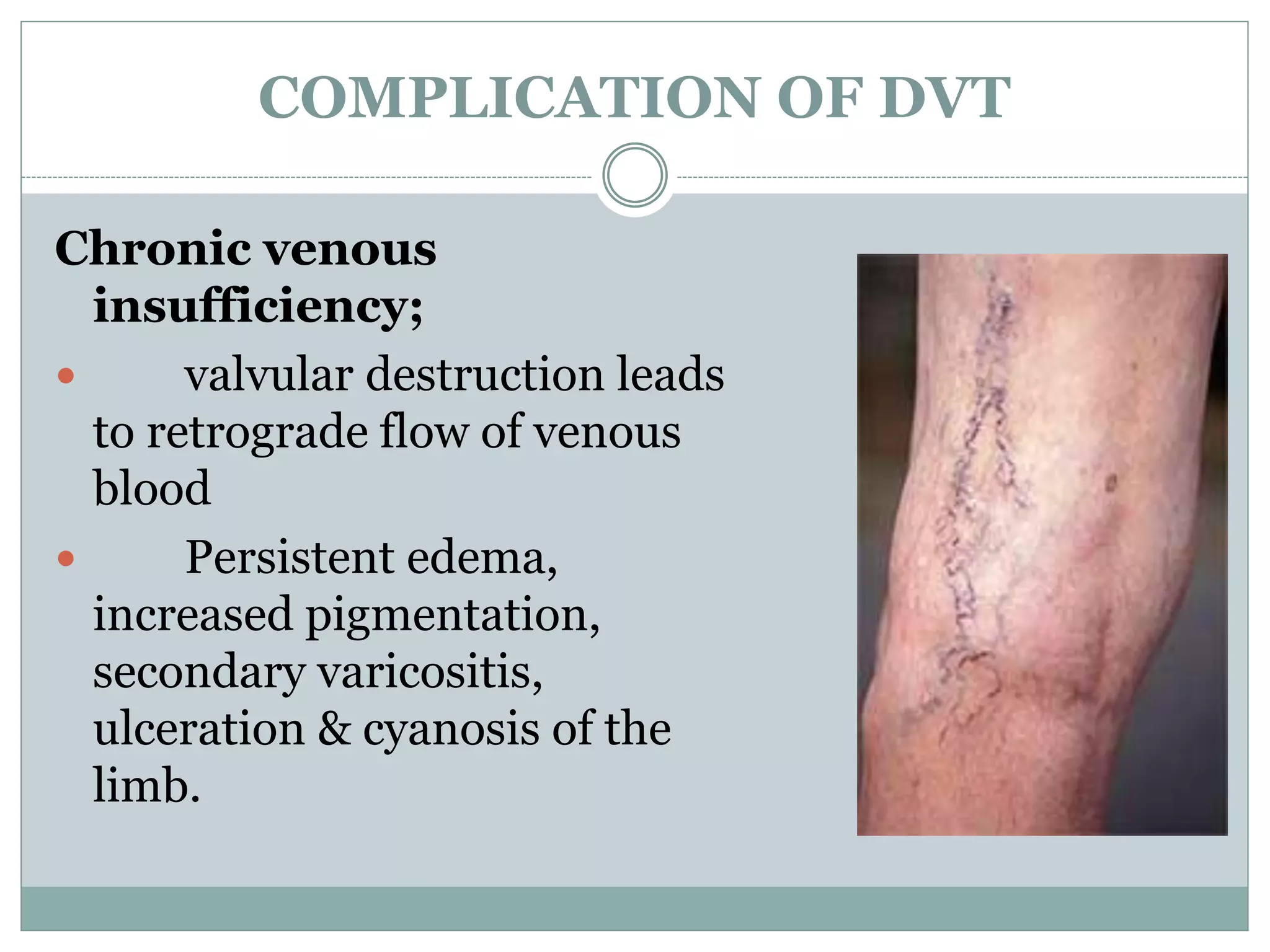 DVT (Deep vein thrombosis) | PDF