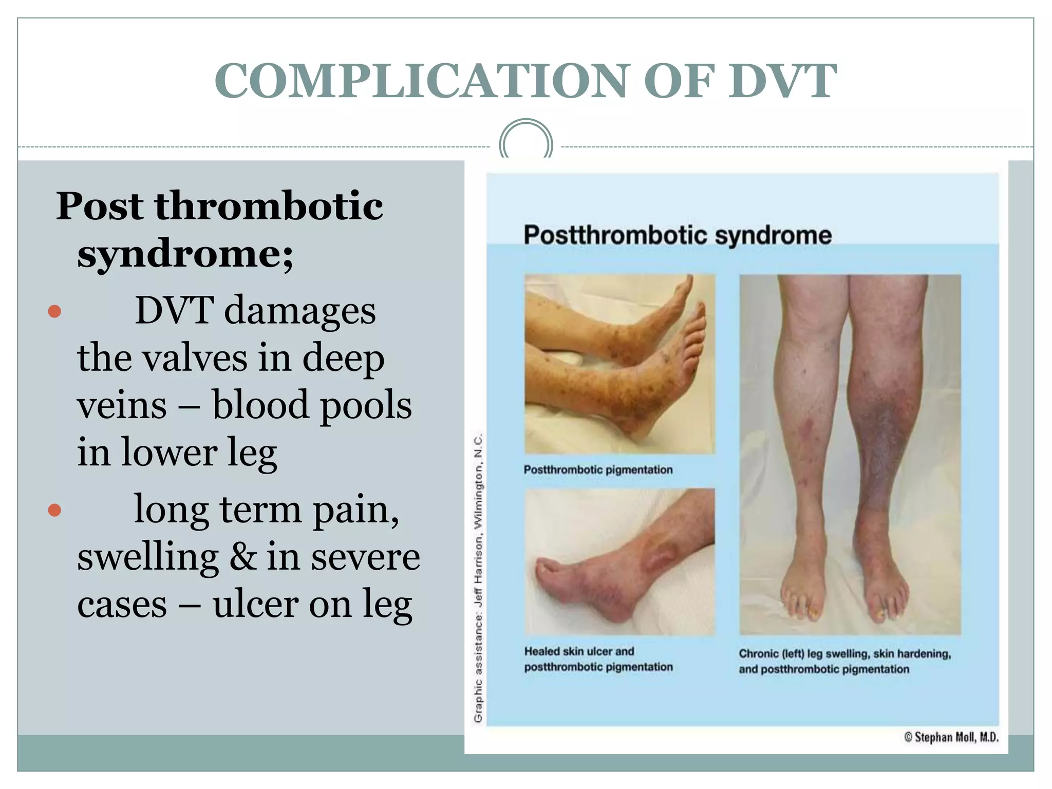 DVT (Deep vein thrombosis) | PDF