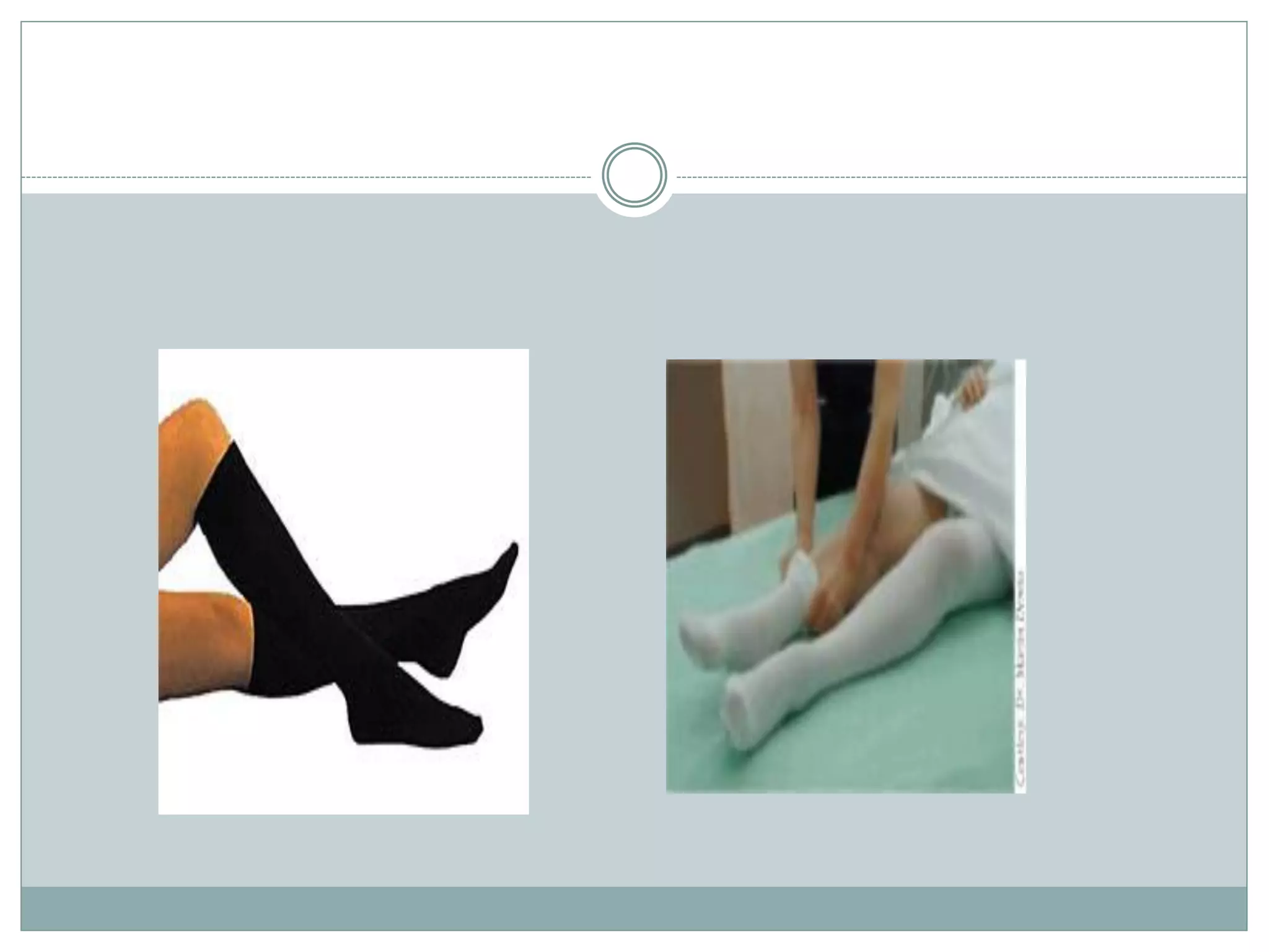 DVT (Deep vein thrombosis) | PDF