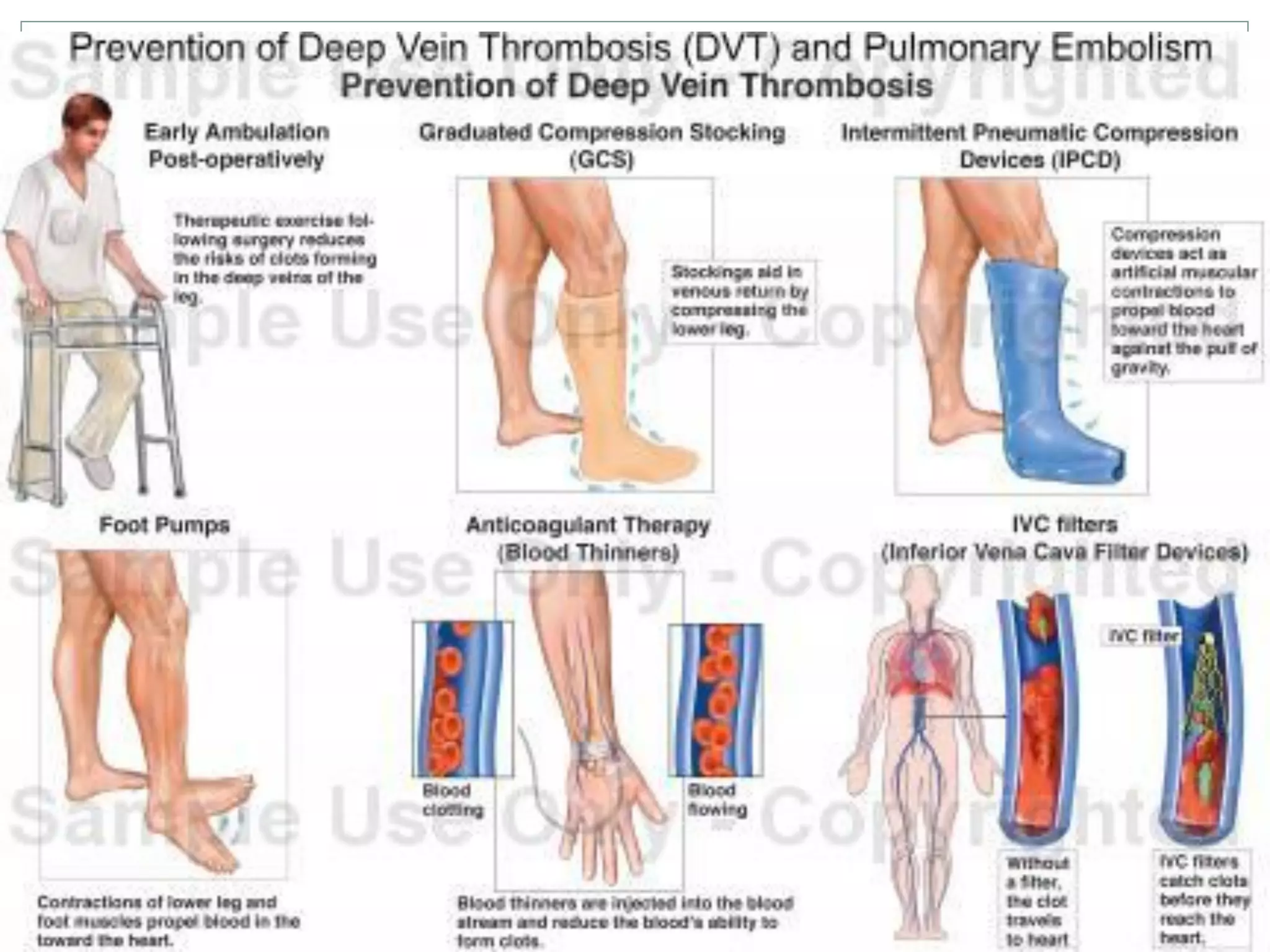 DVT (Deep vein thrombosis) | PDF
