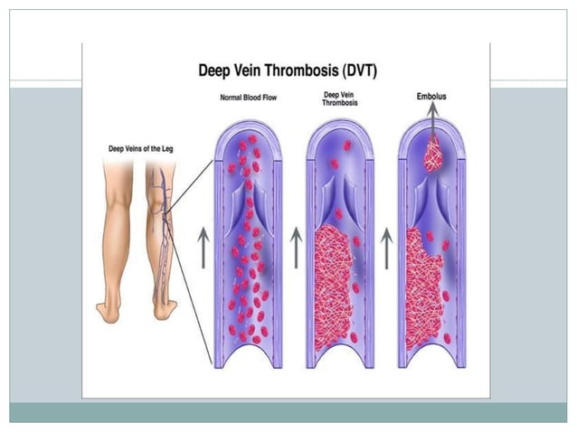 DVT (Deep vein thrombosis) | PDF